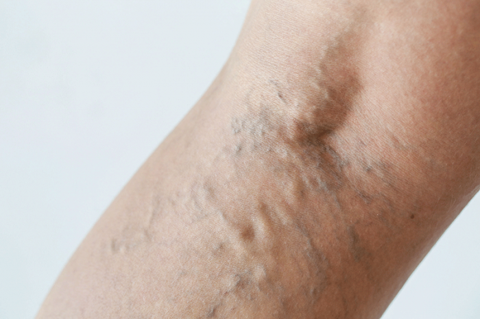 4 Astuces et Conseils pour Éviter les Varices