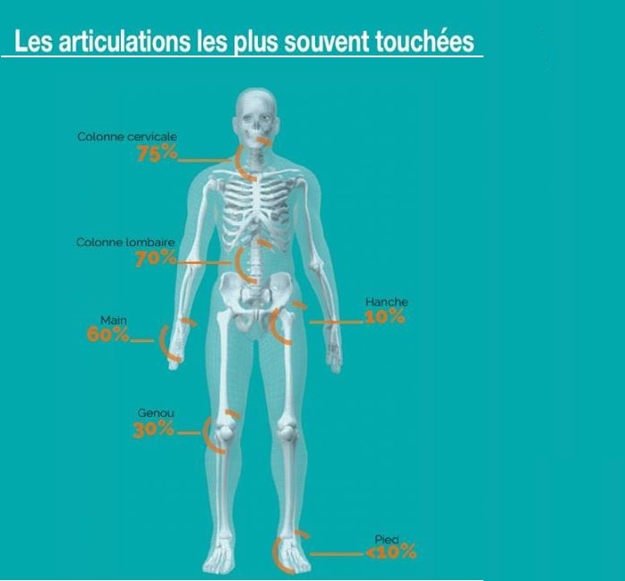 Comment Soulager L'arthrose