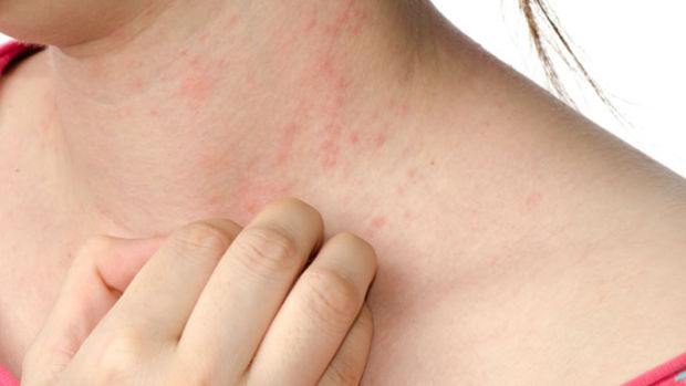 Eczéma, Comment le Soulager?