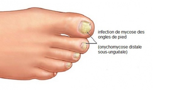 Remèdes Maison pour Éliminer les Mycoses