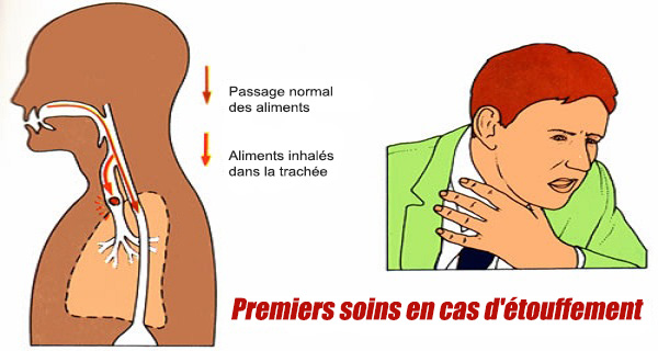 Si vous Commencez à Étouffer et que vous Êtes Seul: Sauvez Votre Vie en ...